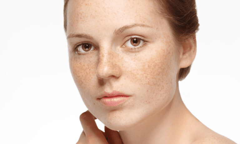 Rosacea: Explore Its Symptoms, Causes, Therapy & Treatment