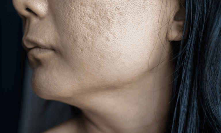 How to Get Rid of Large Pores?
