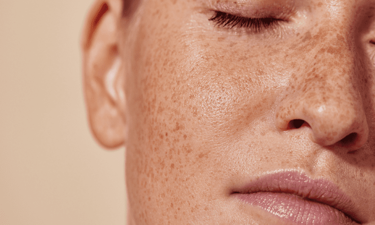 How To Fade Age Spots? Perfect Skin Studio