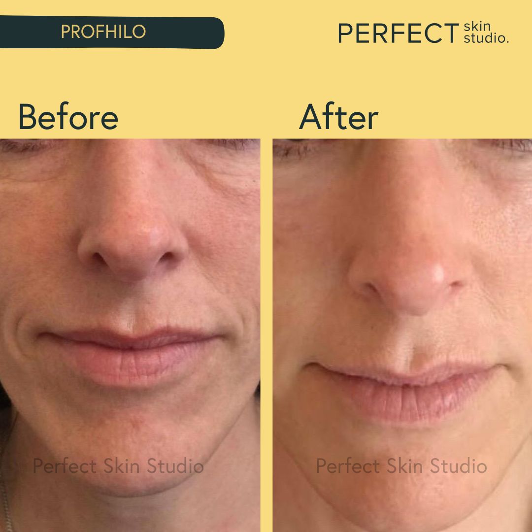 Profhilo Before and After Results | Perfect Skin Studio