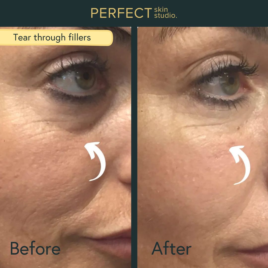 Tear Trough Filler Swelling Stages | Perfect Skin Studio