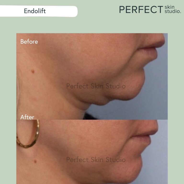 Endolift Before and After: What to Expect | Perfect Skin Studio
