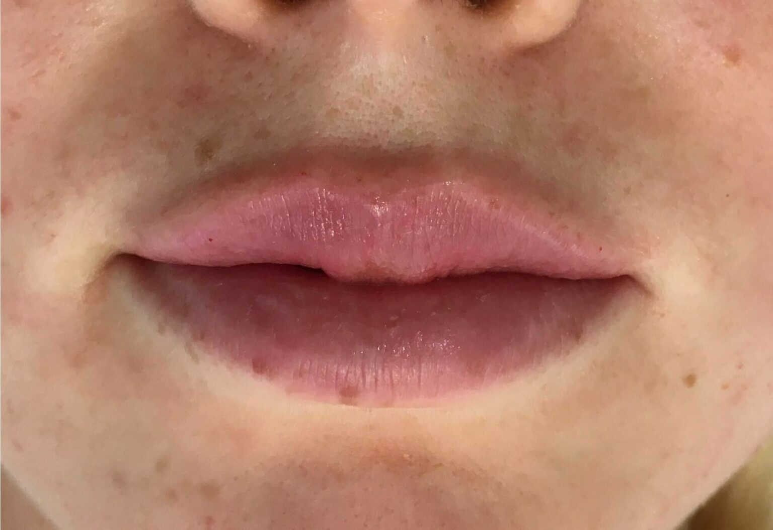 Lip Filler Healing Process: Complete Guide | Perfect Skin Studio