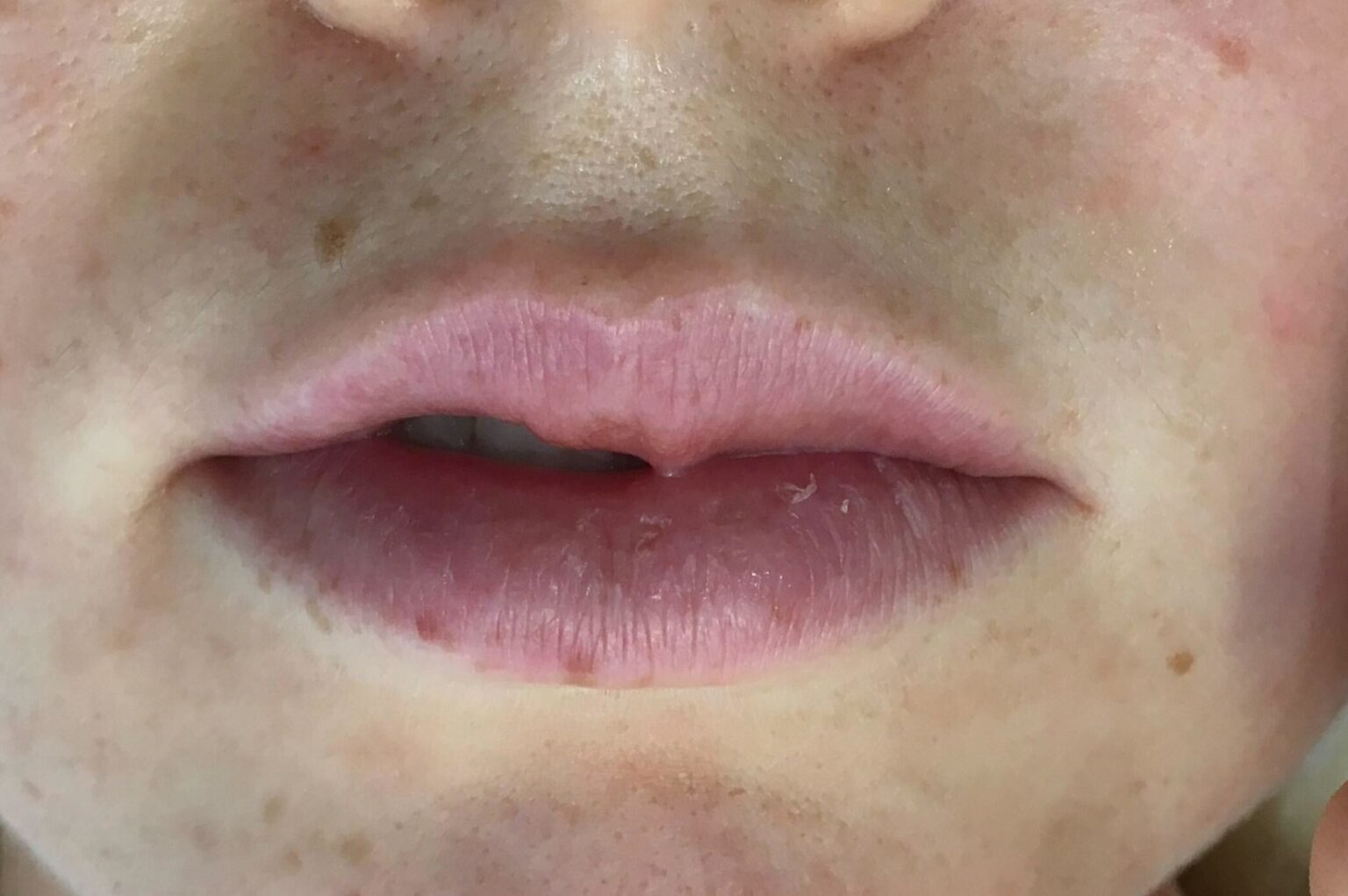 Lip Flip: What It Is, Results, Cost & Aftercare | Perfect Skin Studio
